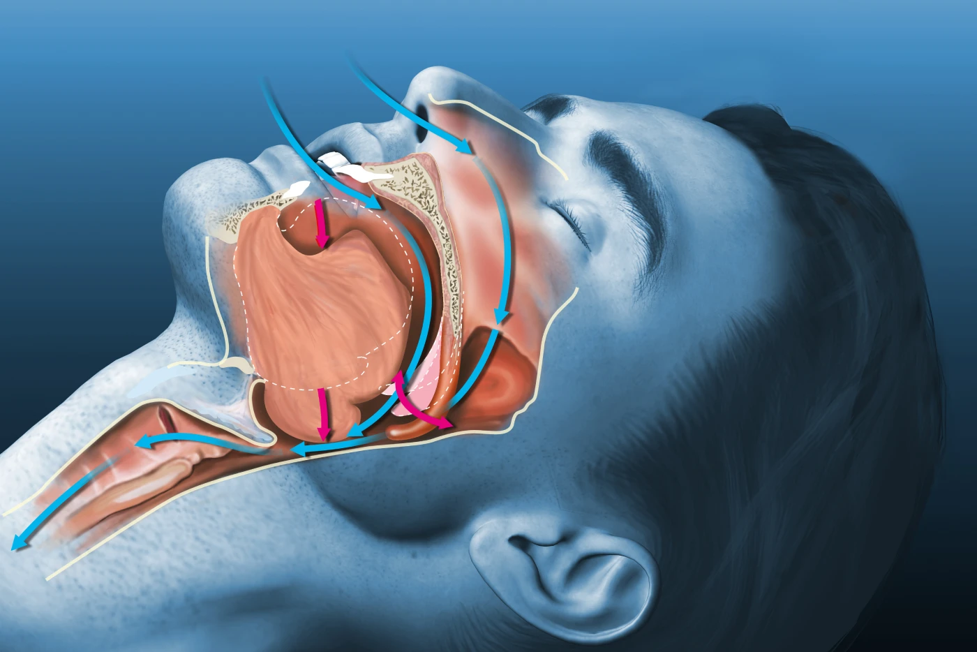 Airway Orthodontics - DFW Deep Sleep Airway TMJ